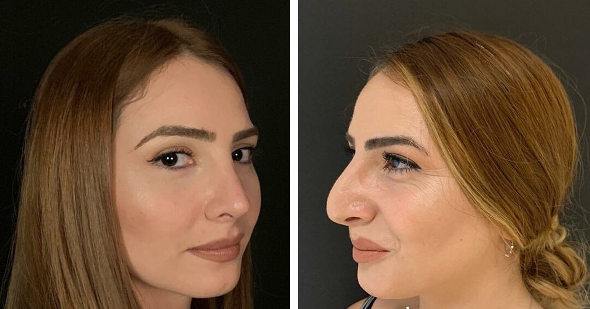 Before and after rhinoplasty: How rhinoplasty changes girls' appearance ...