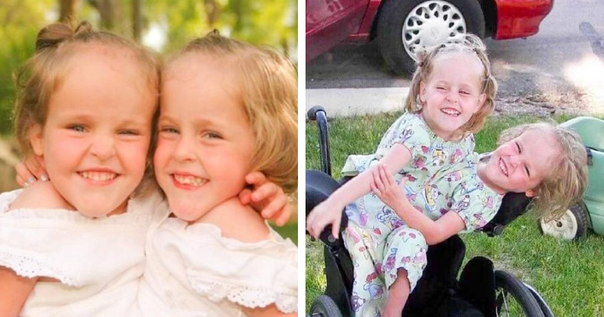 These Siamese Twins Were Separated When They Were Four Years Old, And Now They Are 18 Years Old ...