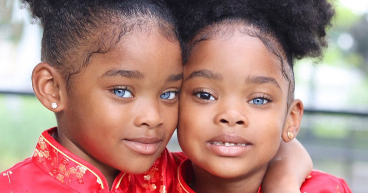 "12 Years Later": What Do Twins With Different Eye Colors Look Like Now ...